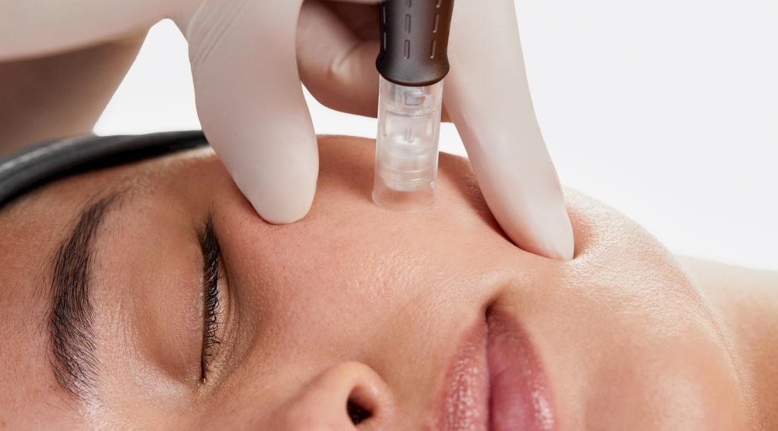 How to achieve superior microneedling results