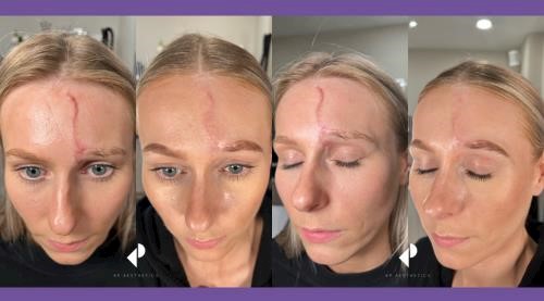 Understanding scars and the potential of new technology for revision