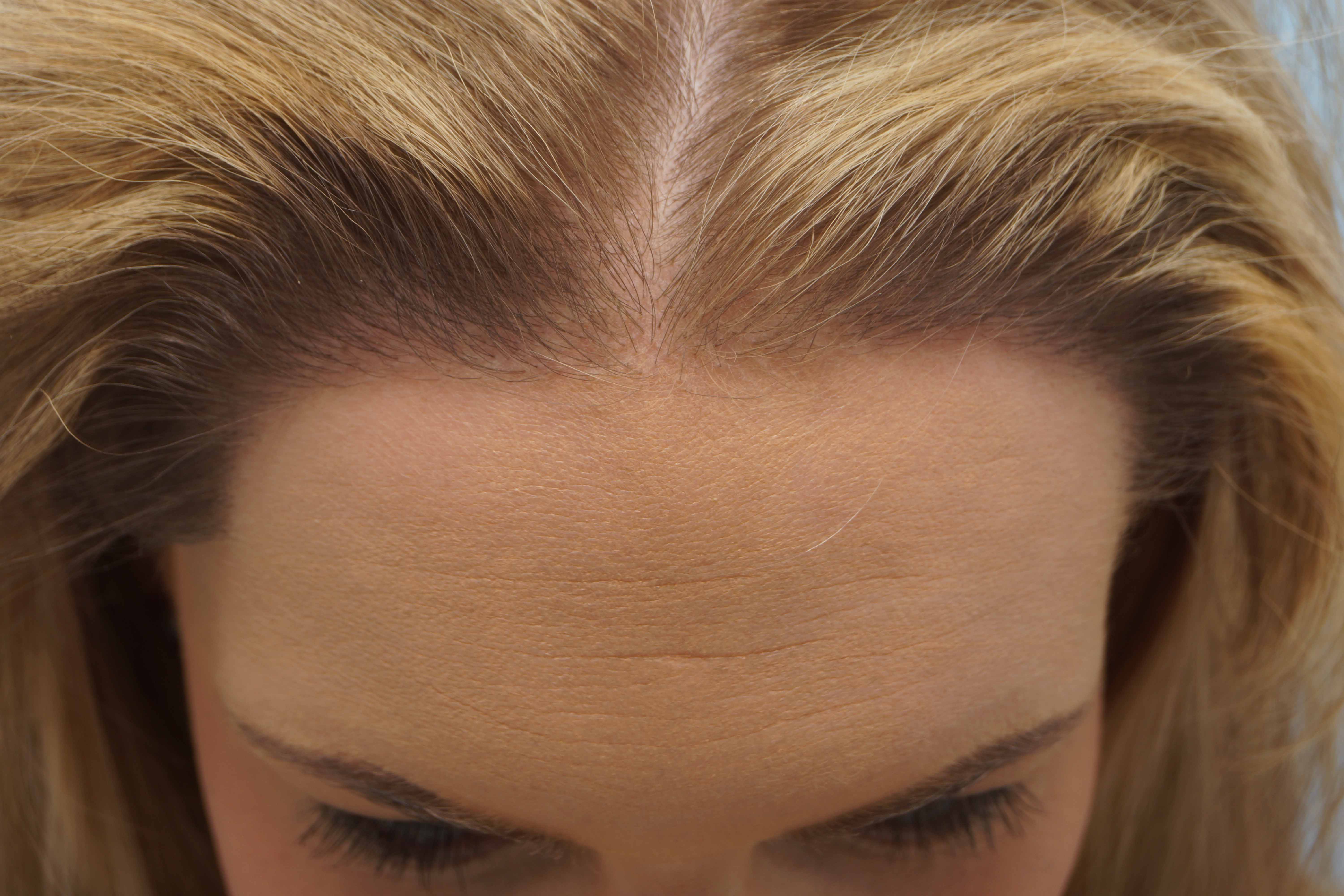 Hair transplants for transgender patients